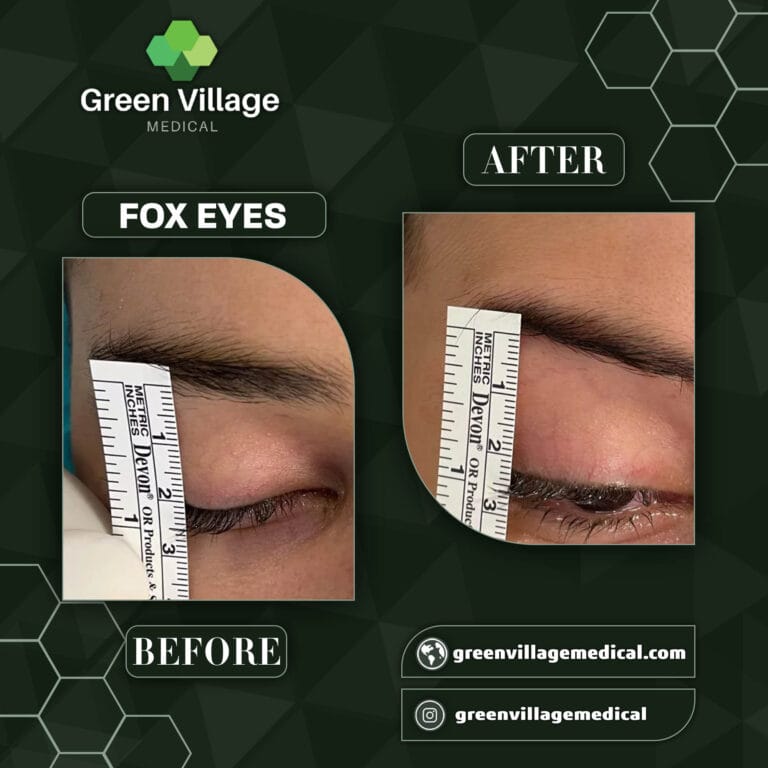 Fox Eye Surgery - Green Village Medical