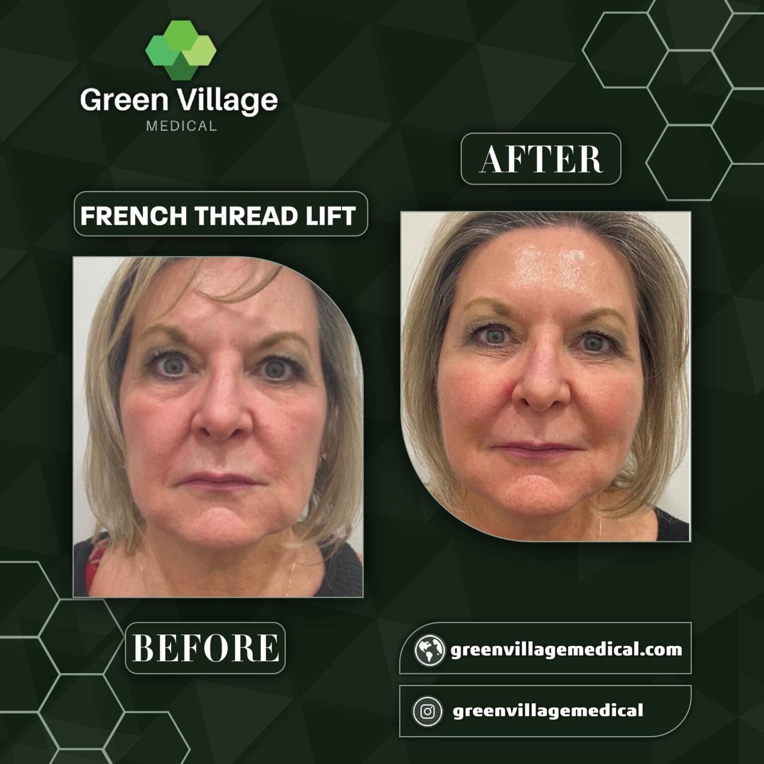 French Lift - Green Village Medical