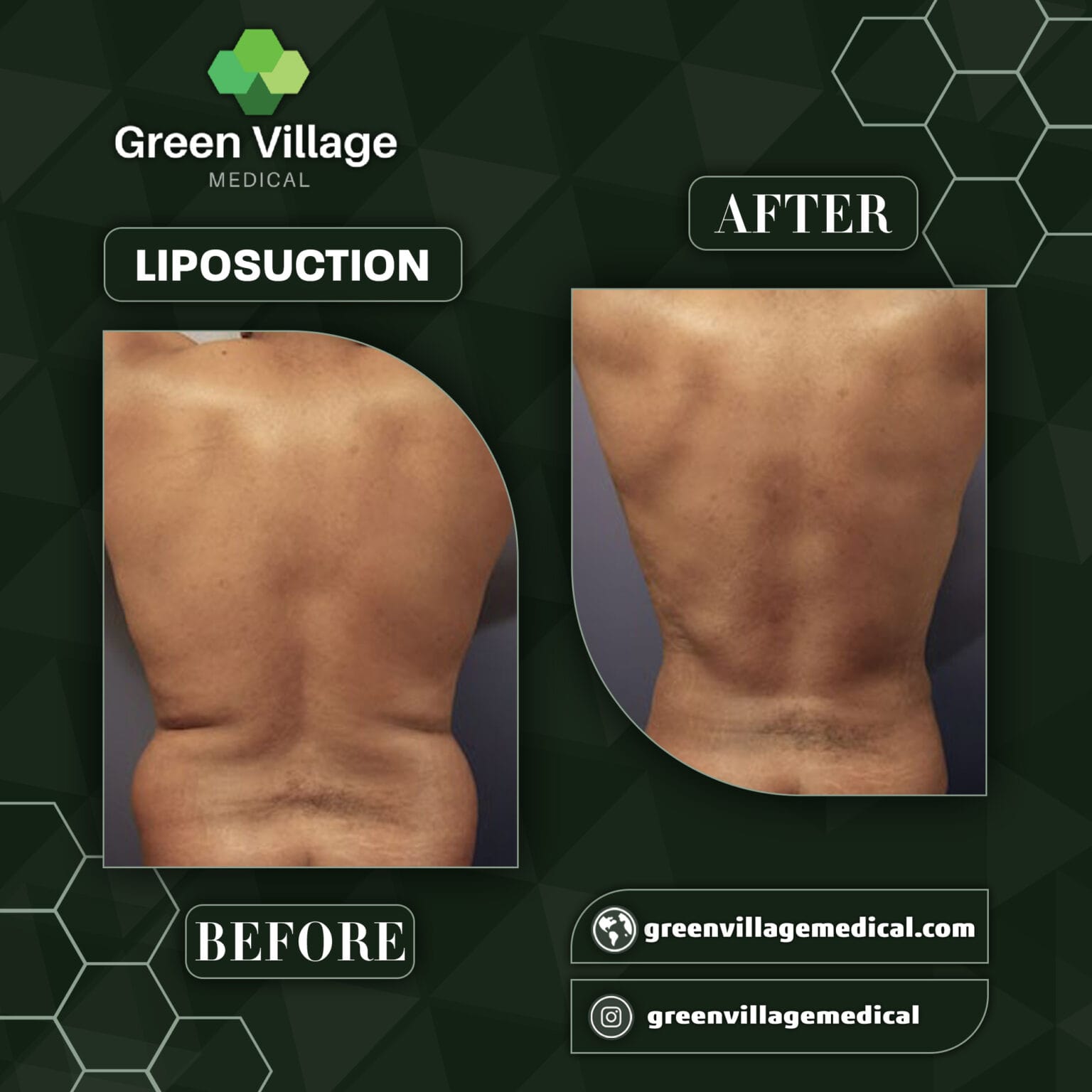 Liposuction - Green Village Medical