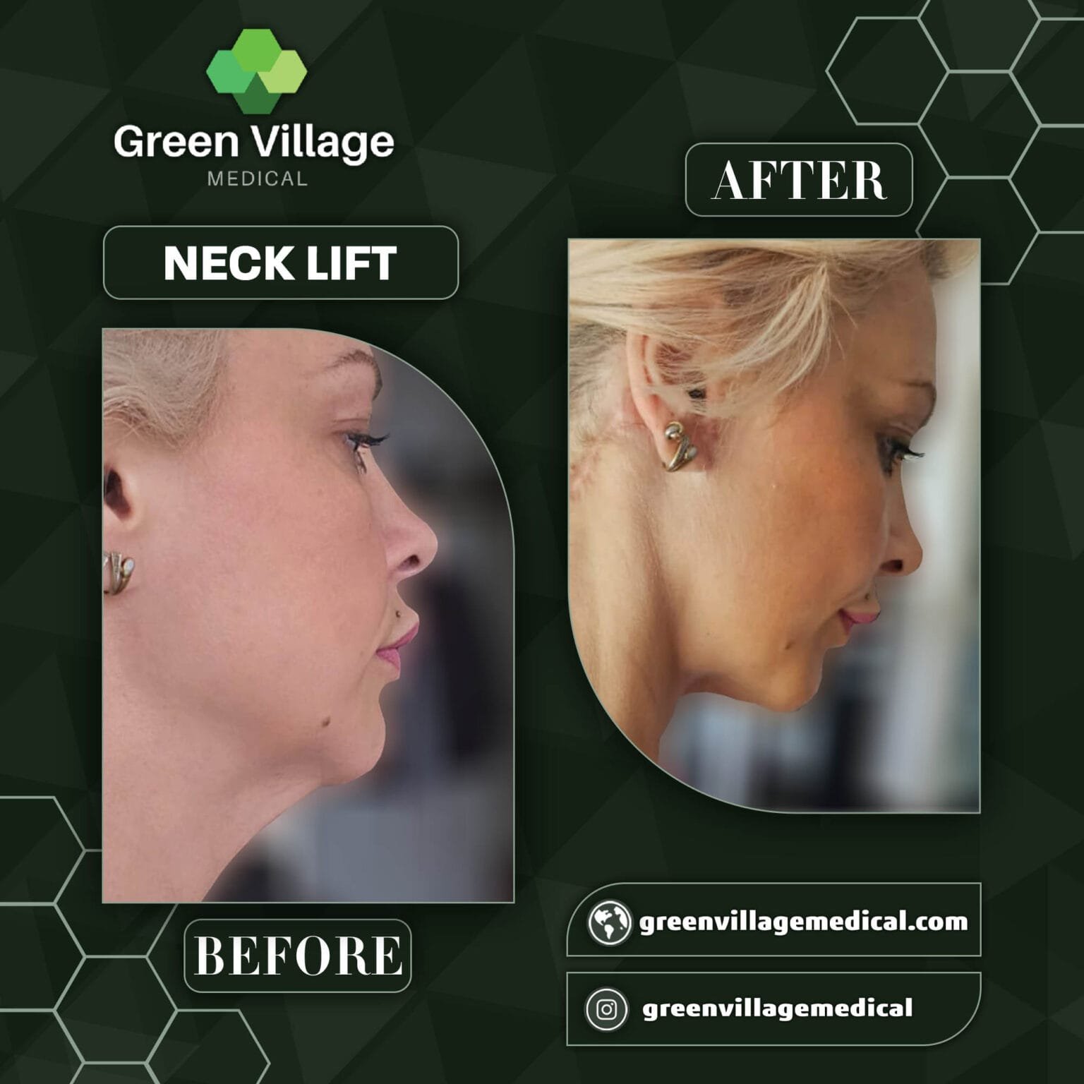 Neck Lift Surgery - Green Village Medical